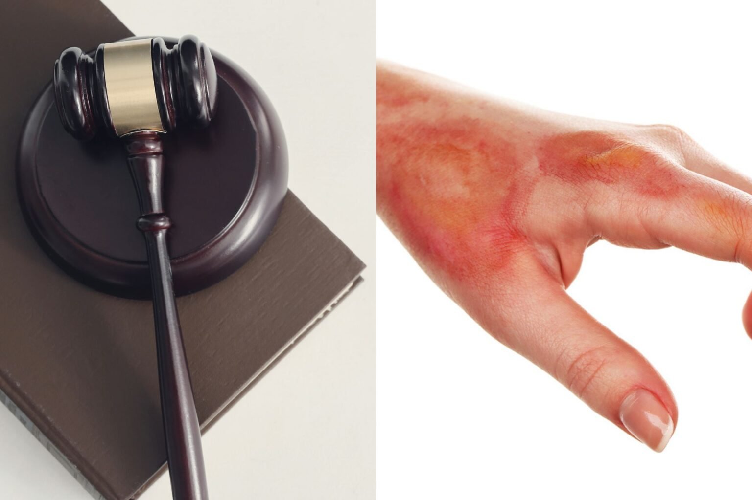 What Types of Damages Can You Recover in a Burn Injury Case? - Lawguage